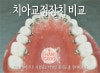 세라믹교정 클리피씨교정 메탈교정 투명교정 설측교정 네이버 블로그